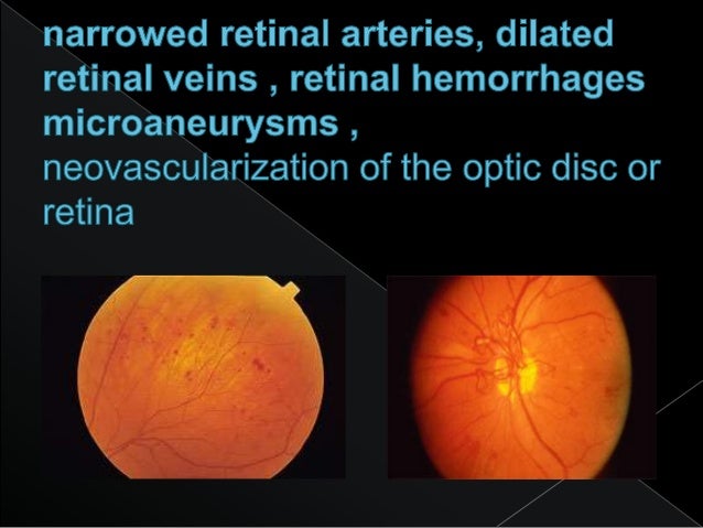 Central Retinal Artery Occlusion Boxcar