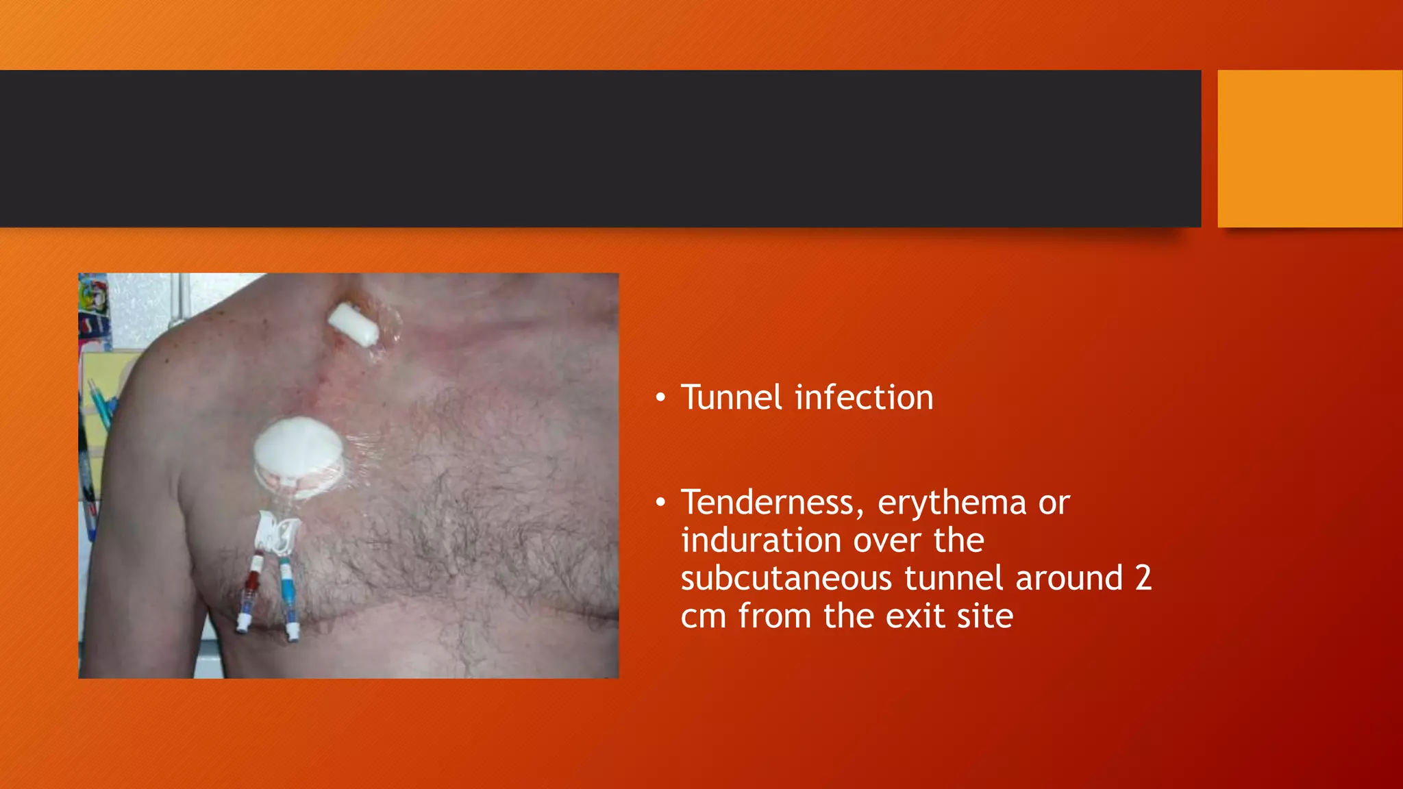 CATHETER RELATED BLOOD STREAM INFECTION | PPTX