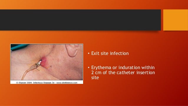 CATHETER RELATED BLOOD STREAM INFECTION