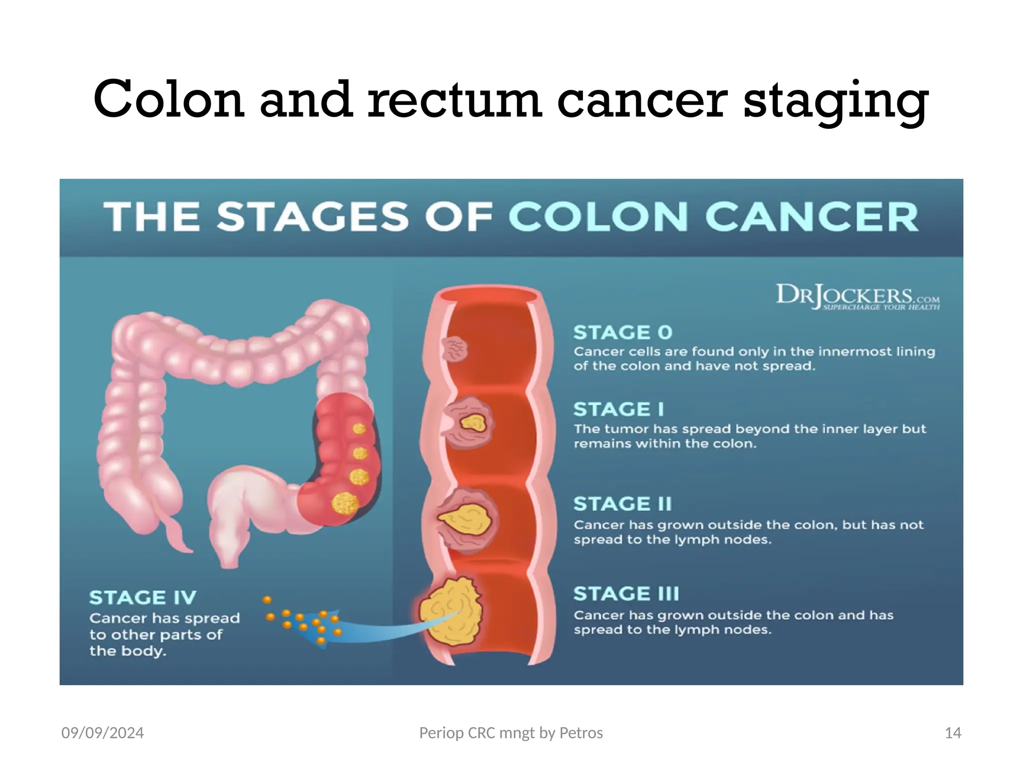 Peri-operative management of Colo-rectal Cancer | PPTX