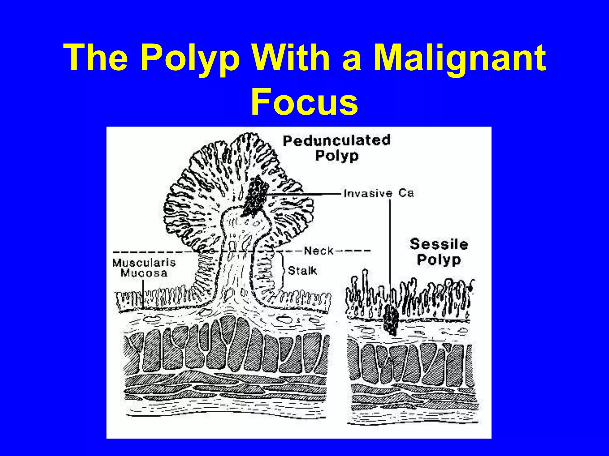 Crc, colorectal polyps (2) | PPT