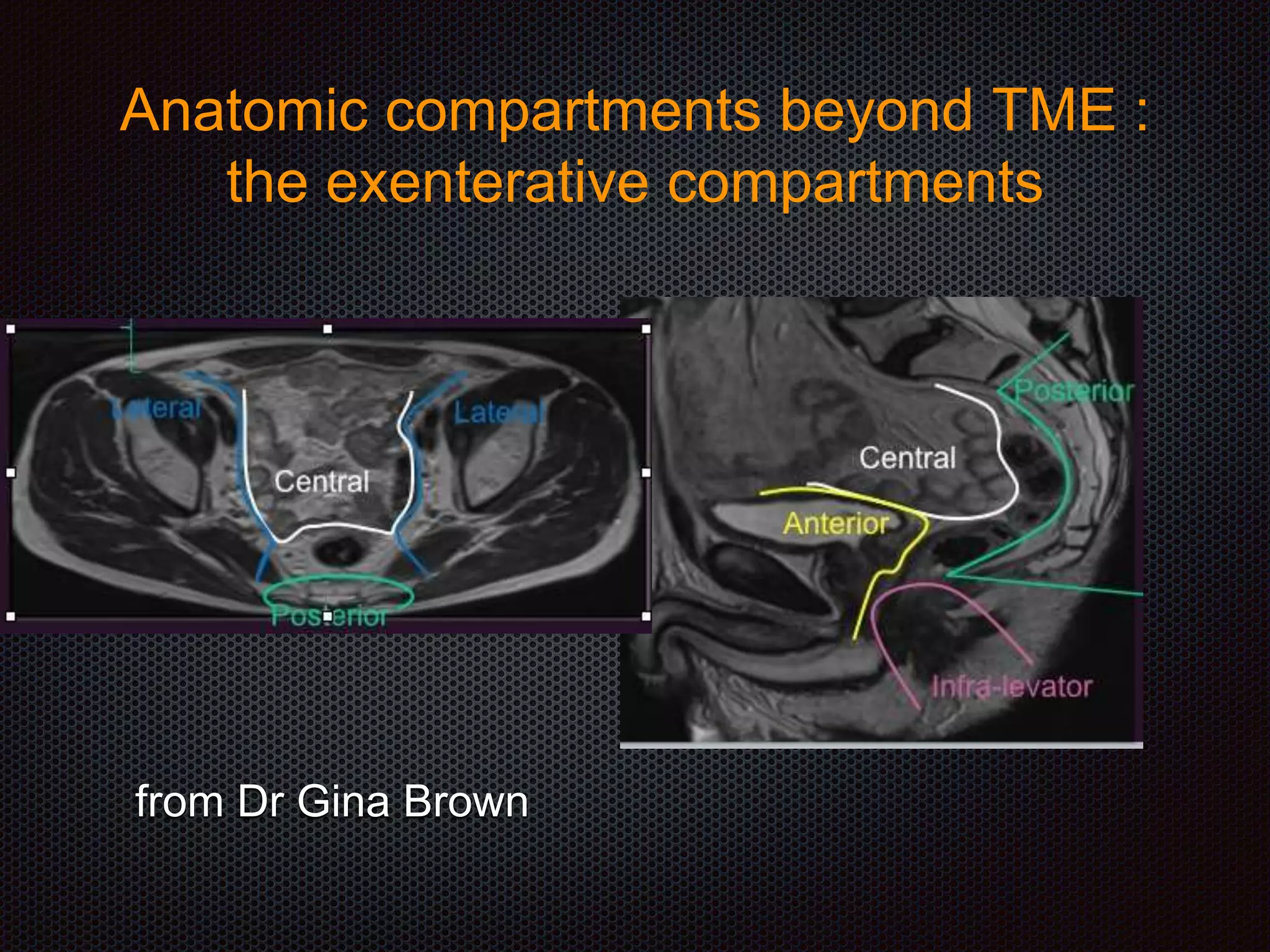 Ca Rectum Imaging | PPTX