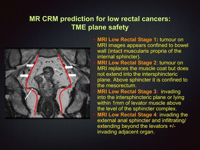 Ca Rectum Imaging | PPTX | Digestive Disorders | Diseases and Conditions