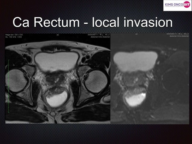 Ca Rectum Imaging | PPT