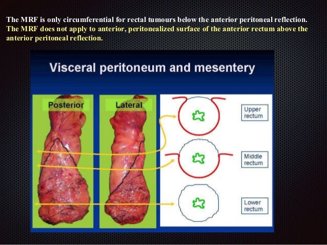 Ca Rectum Imaging