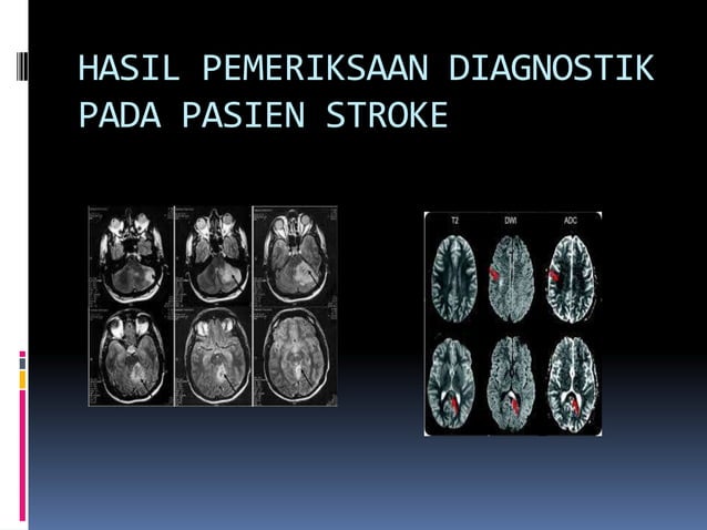 konsep medis stroke nonhemoragik | PPT