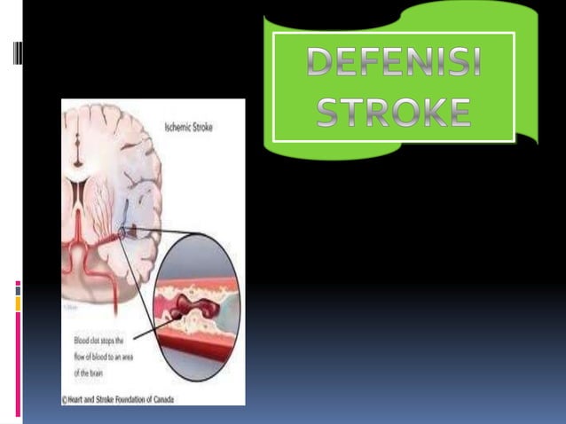 konsep medis stroke nonhemoragik | PPT