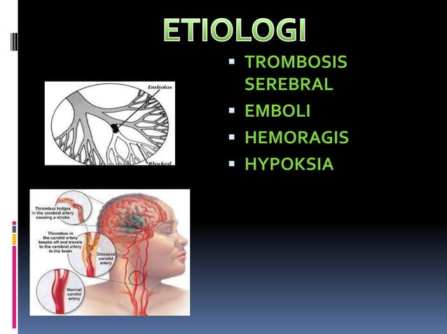 konsep medis stroke nonhemoragik | PPT