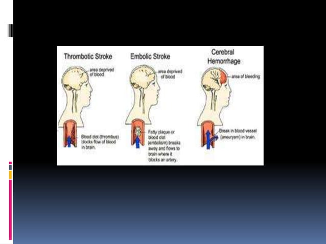 konsep medis stroke nonhemoragik | PPT