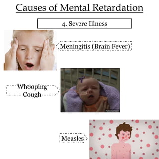 Mental Retardation | PPTX