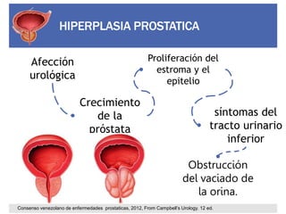 Hiperplasia prostatica.pptx