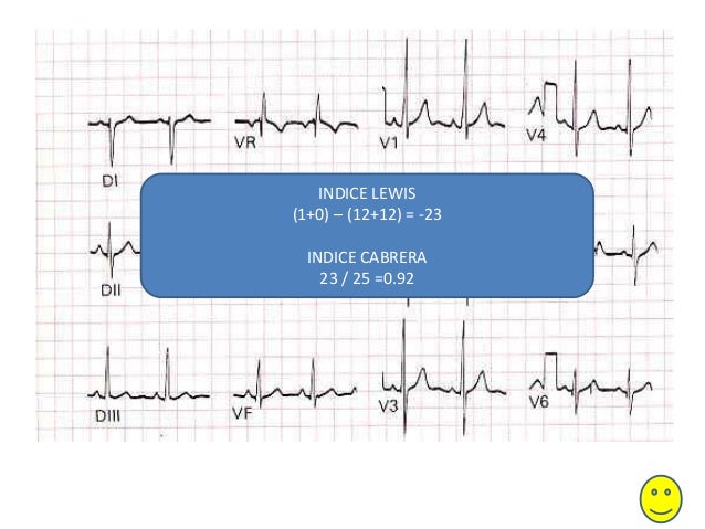 Crecimientos auriculares y ventriculares