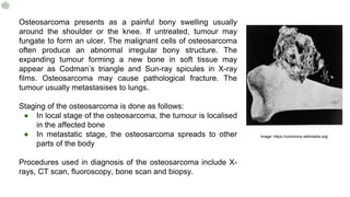 Bone Cancer | PPT