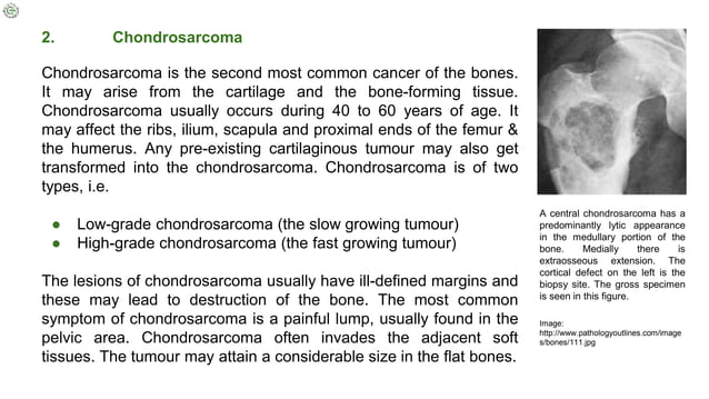 Bone Cancer | PPT