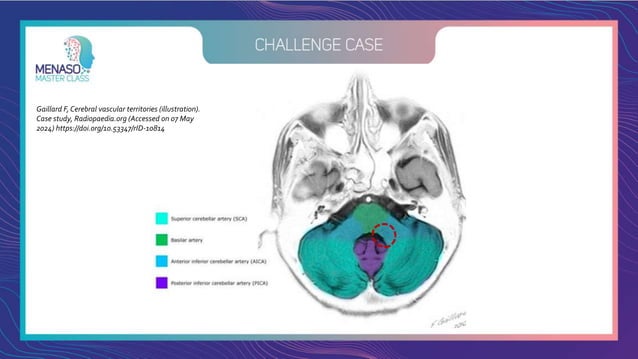 Creeping Stroke - Venous thrombosis presenting with pc-stroke.pptx