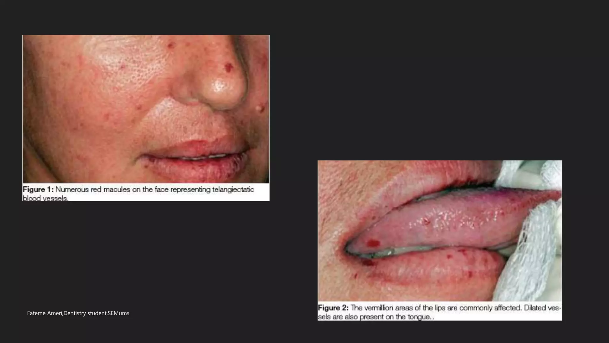 Crest syndrome | PPTX