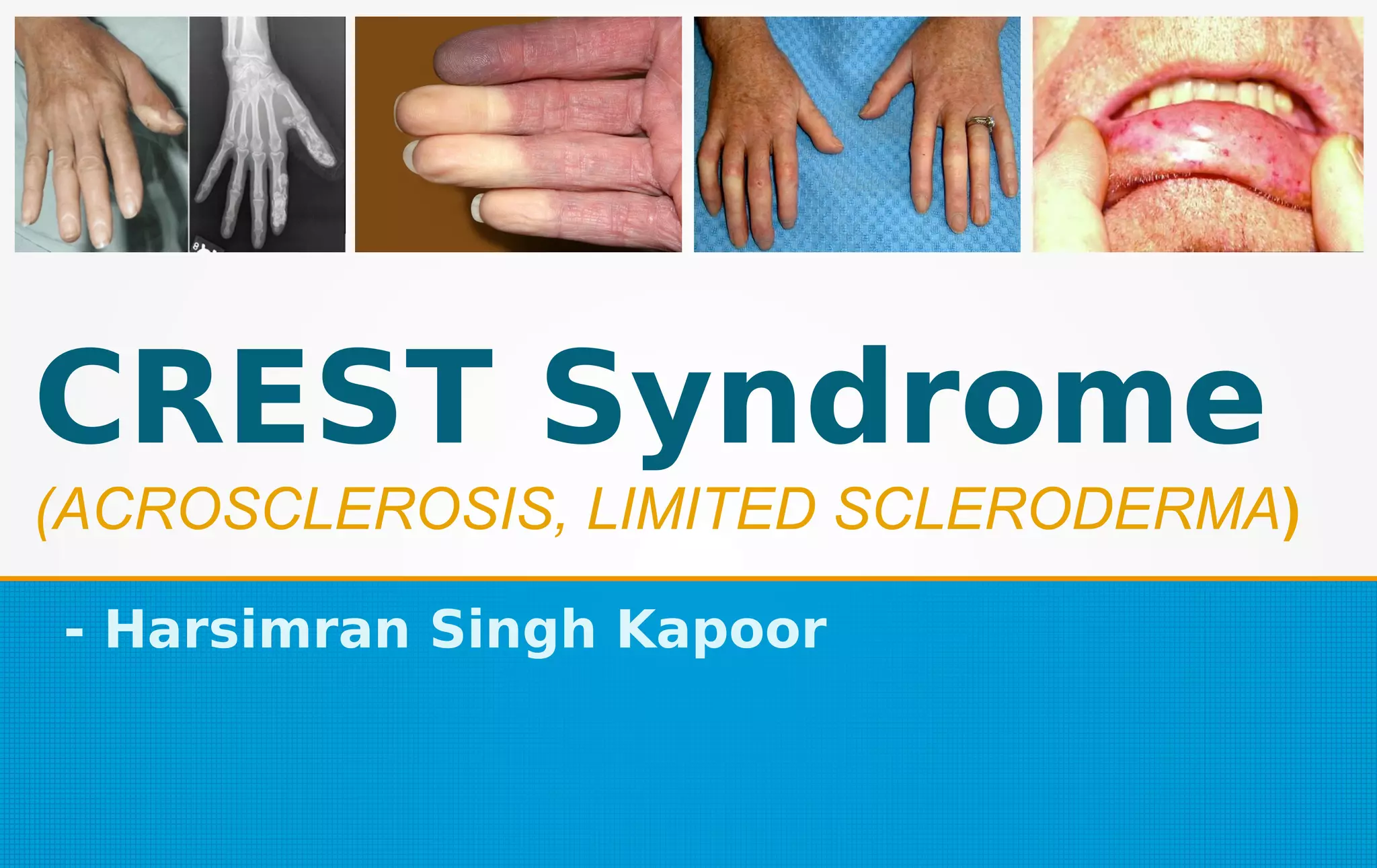CREST Syndrome | PDF