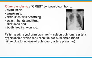 CREST Syndrome | PDF