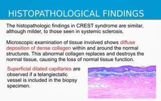 CREST Syndrome | PDF