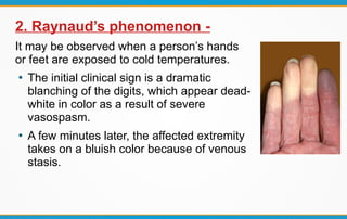 Crest Syndrome Hands