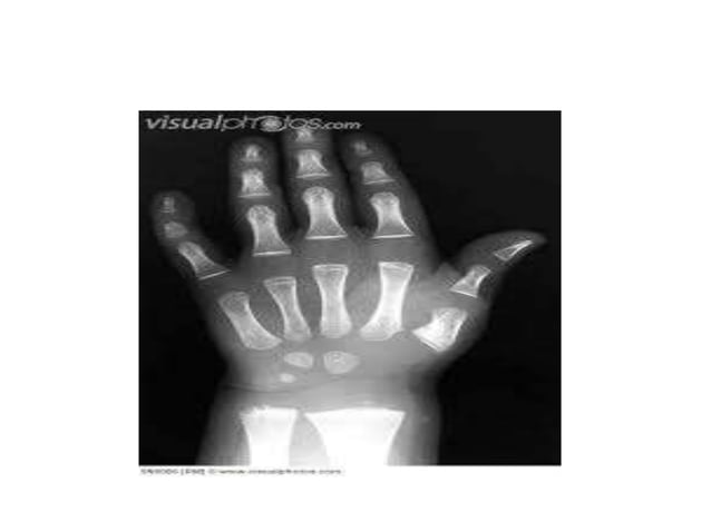 Cretinism & hypothyroidism in children | PPTX