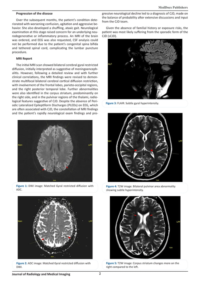 creutzfeldt-jakob-disease-CJD-a-case-report-and-the-role-of ...