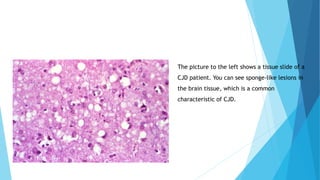 Creutzfeldt jakob disease | PPTX