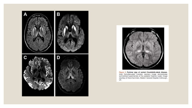 Creutzfeldt Jakob Disease | PPTX