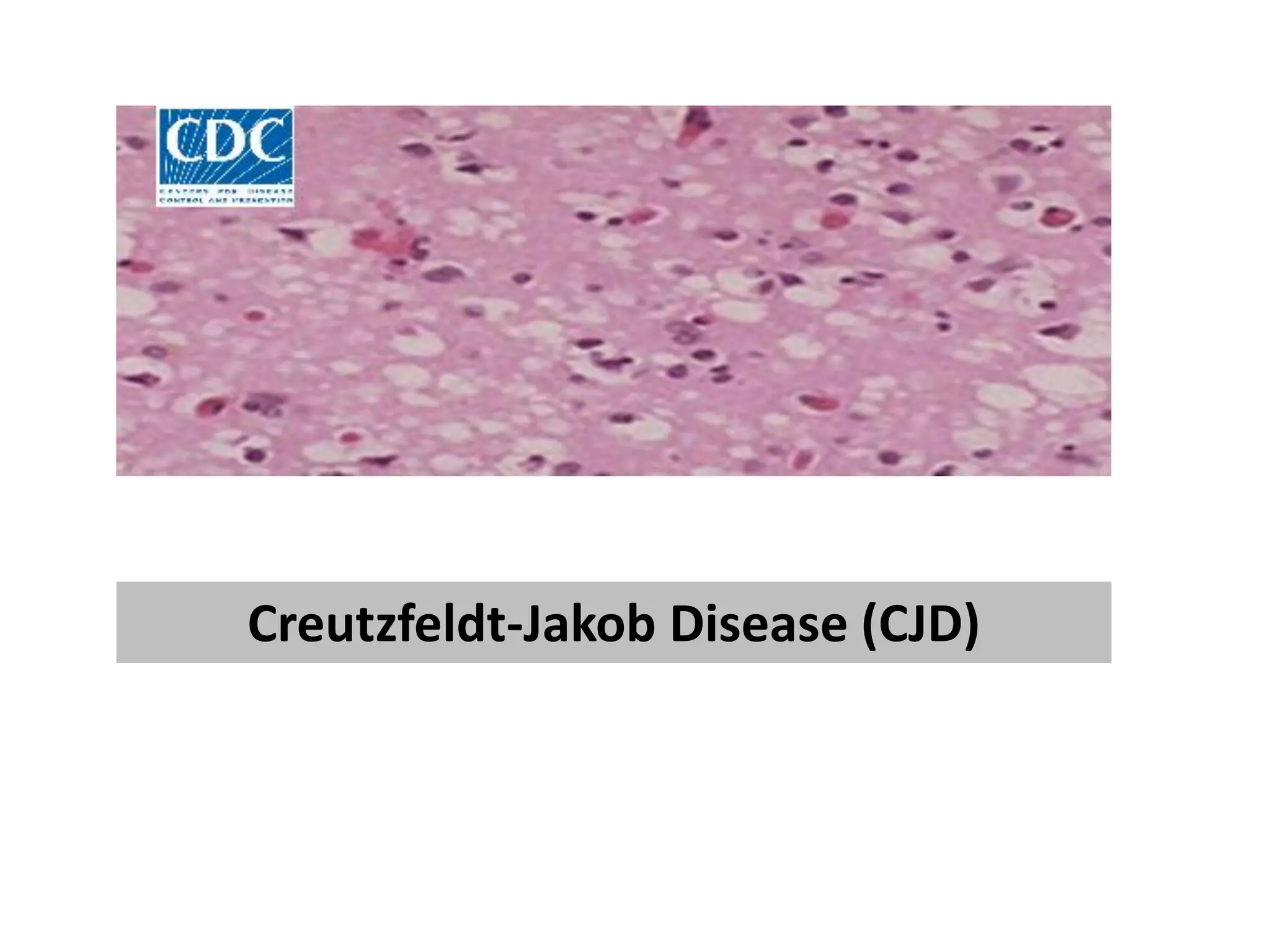 Creutzfeldt jakob disease (cjd) | PDF