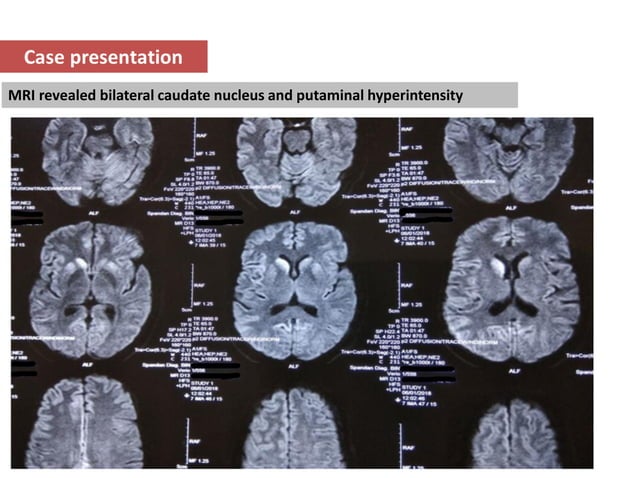Creutzfeldt jakob disease (cjd) | PDF | Brain and Nervous System ...