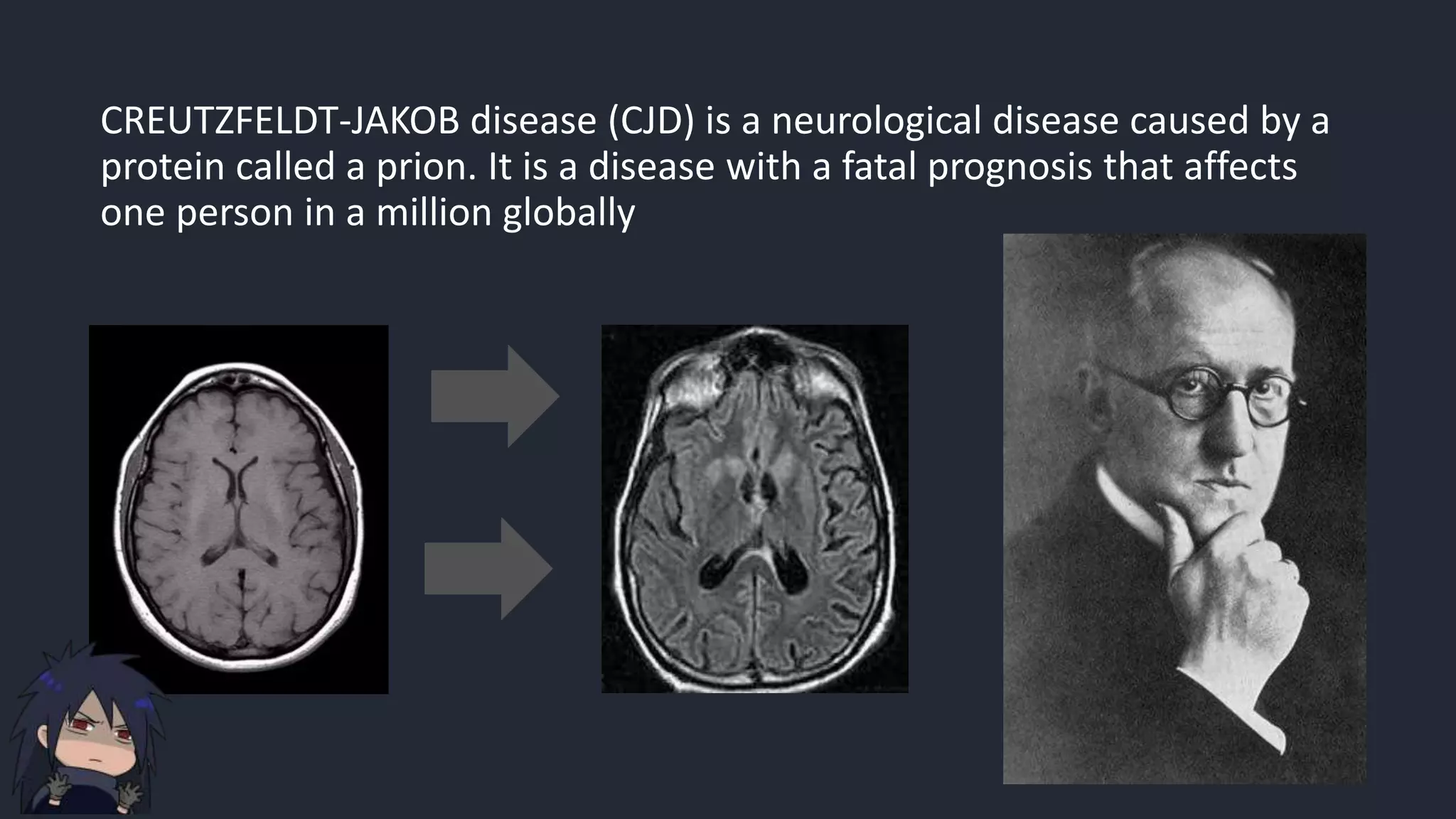 Creutzfeldt jakob | PPTX