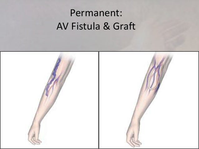 RENAL PATIENTS FOR VASCULAR ACCESS : PERI-OPERATIVE MANAGEMENT…