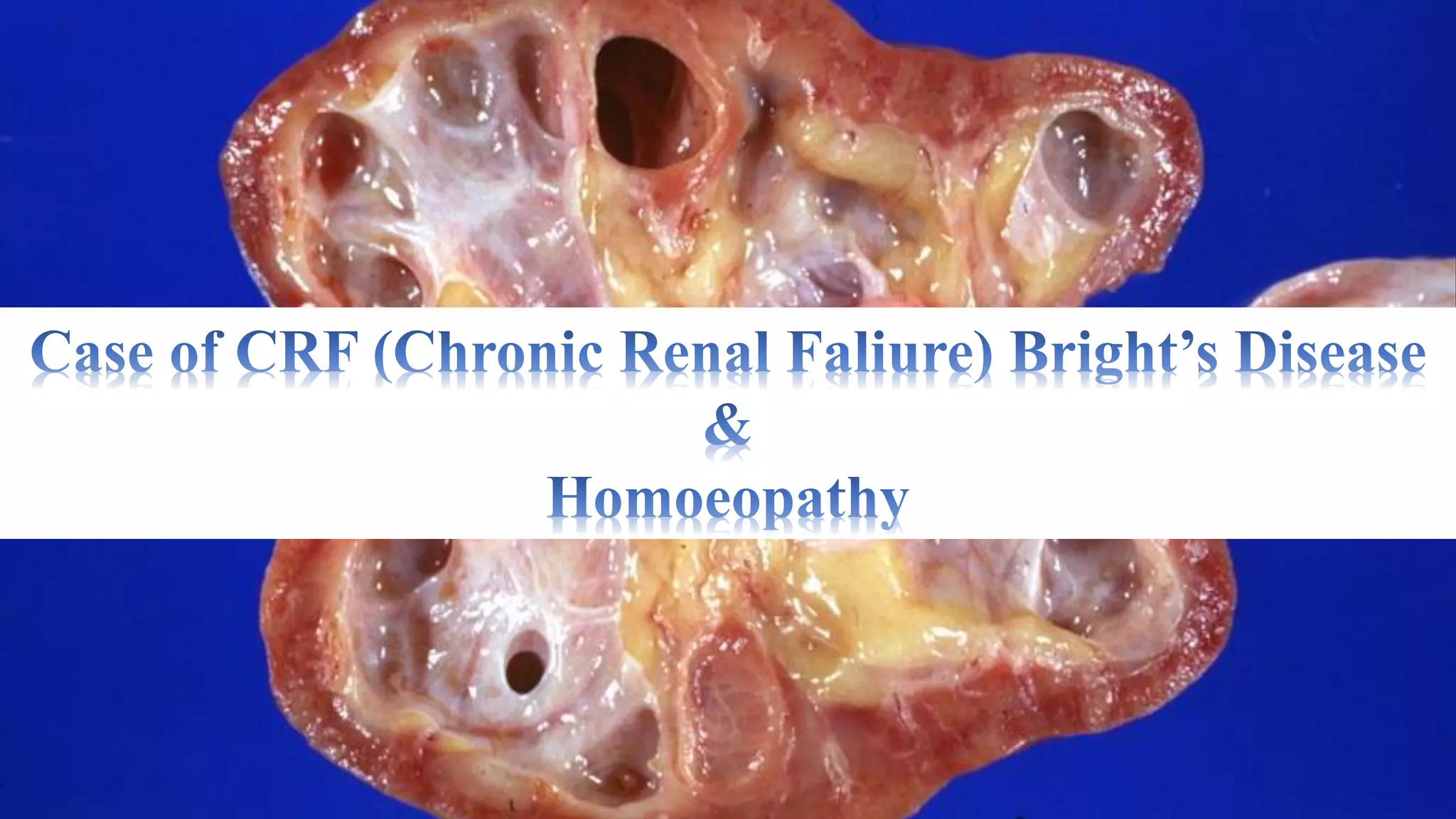 Renal Failure (Bright's Disease) & Homoeopathy (गुर्दा के खराब होने का होम्योपैथी उपचार) | PDF ...
