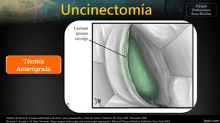Cirugia Endoscópica de Seno Maxilar | PPTX