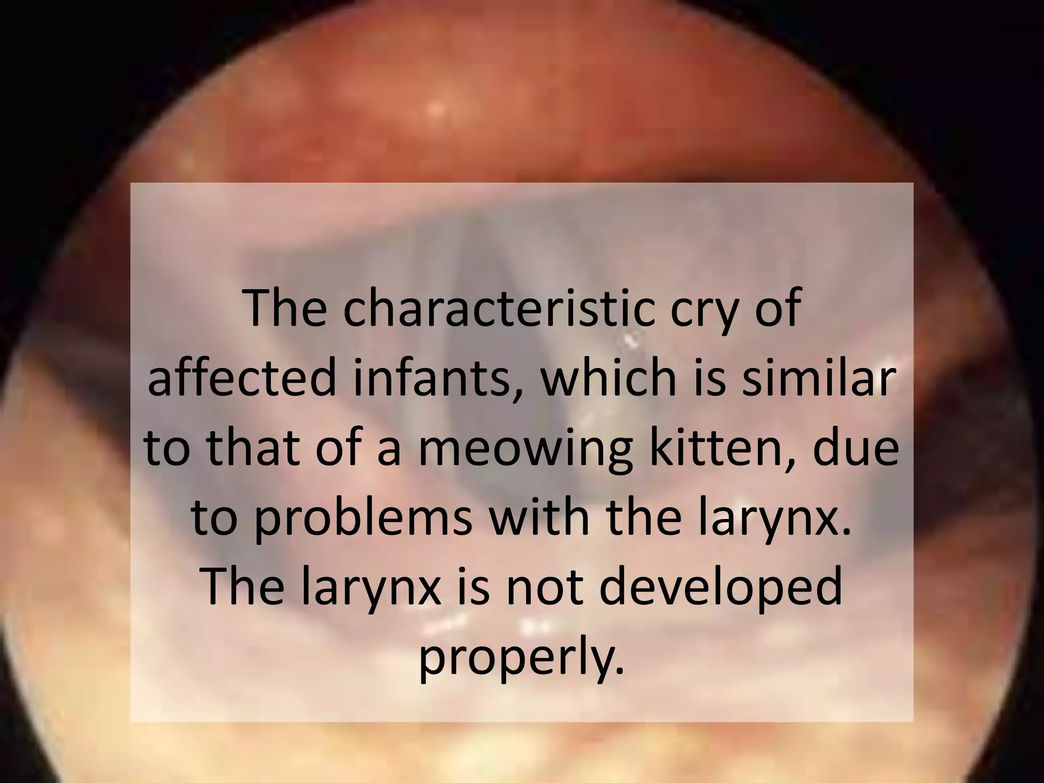 Cri du-chat syndrome | PPTX