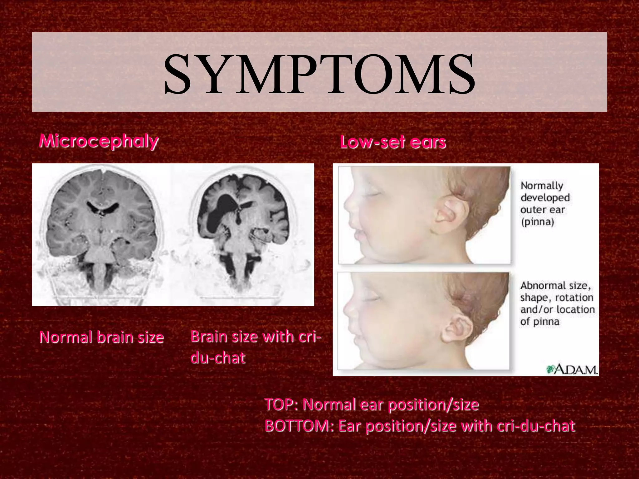 Cri du-chat syndrome | PPTX