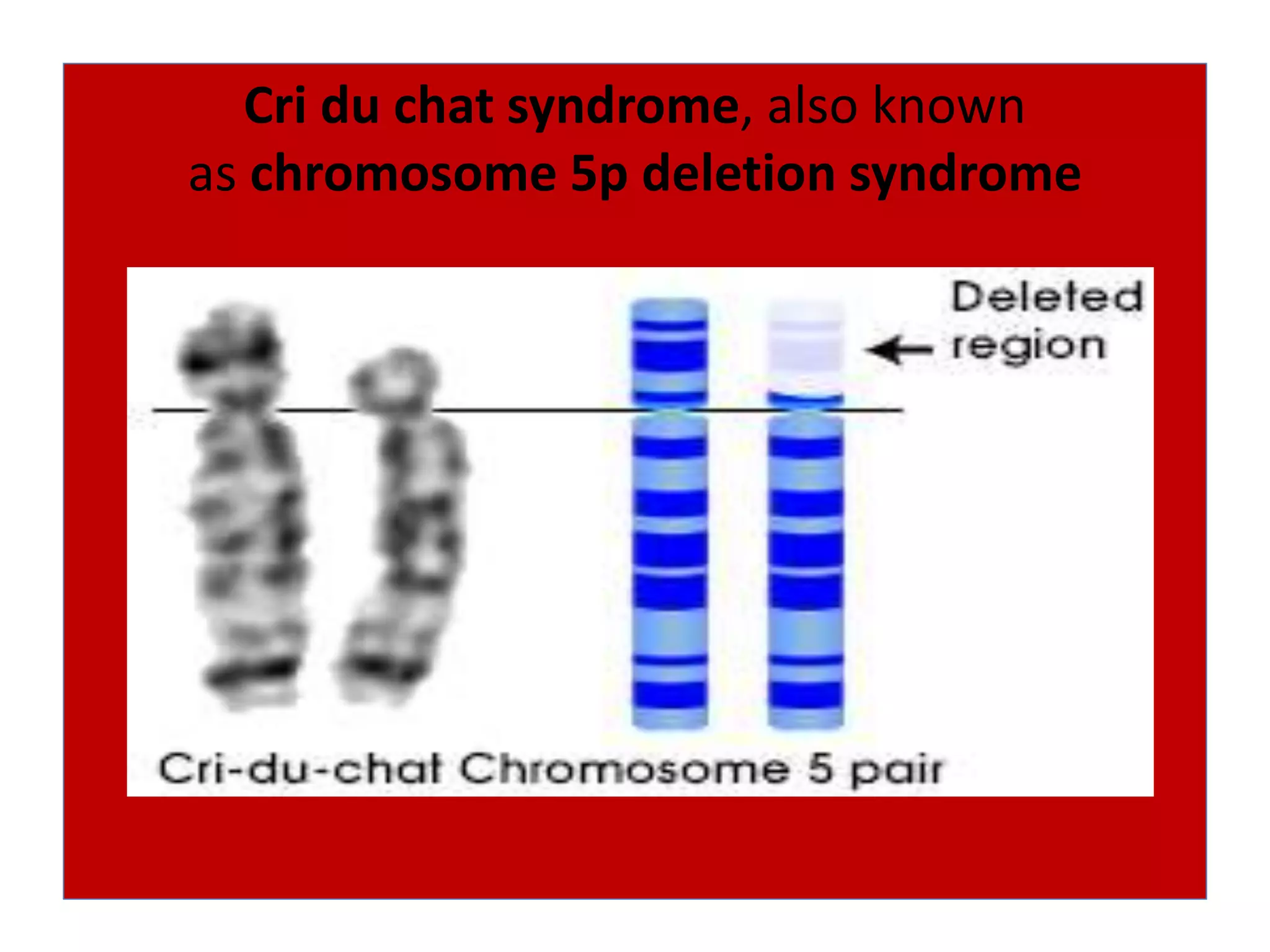 Cri du-chat syndrome