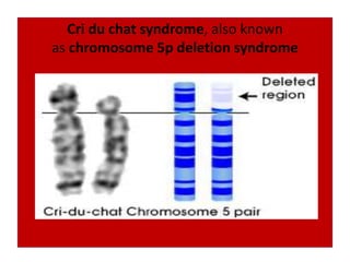 Cri du-chat syndrome | PPTX