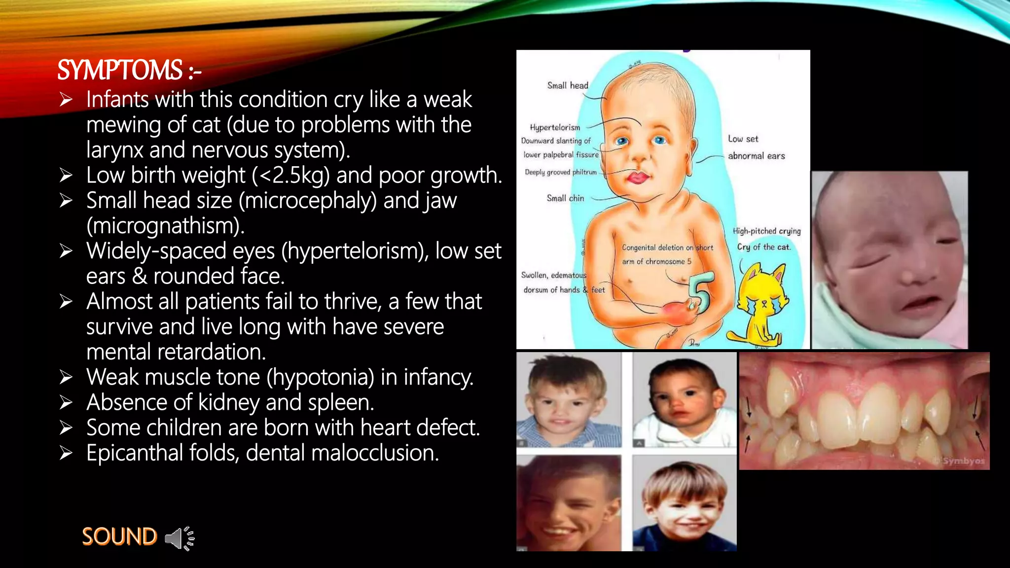 Cri-du-chat syndrome by Herojit.pptx