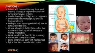 Cri-du-chat syndrome by Herojit.pptx