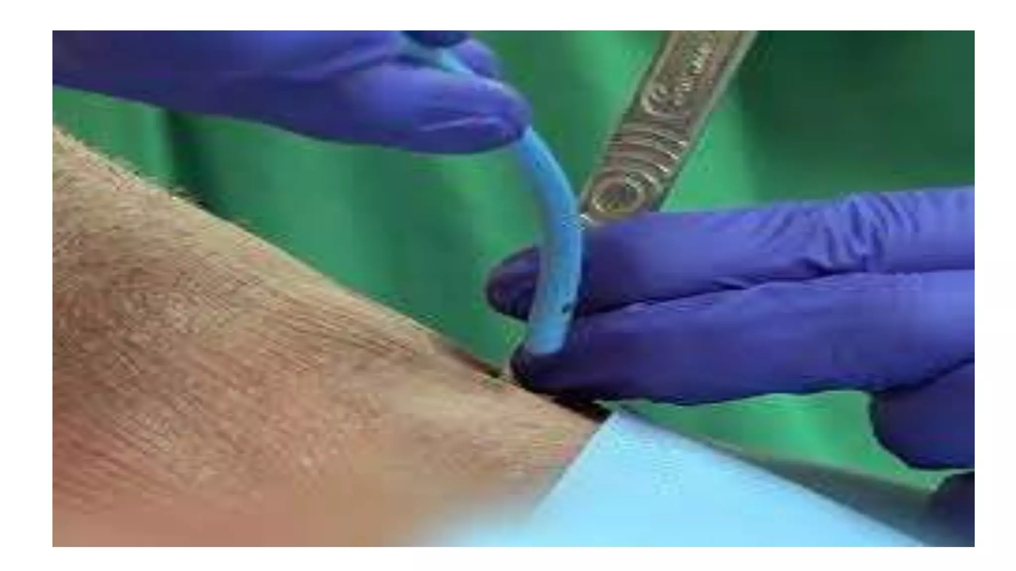 Cricothyroidotomy | PPTX