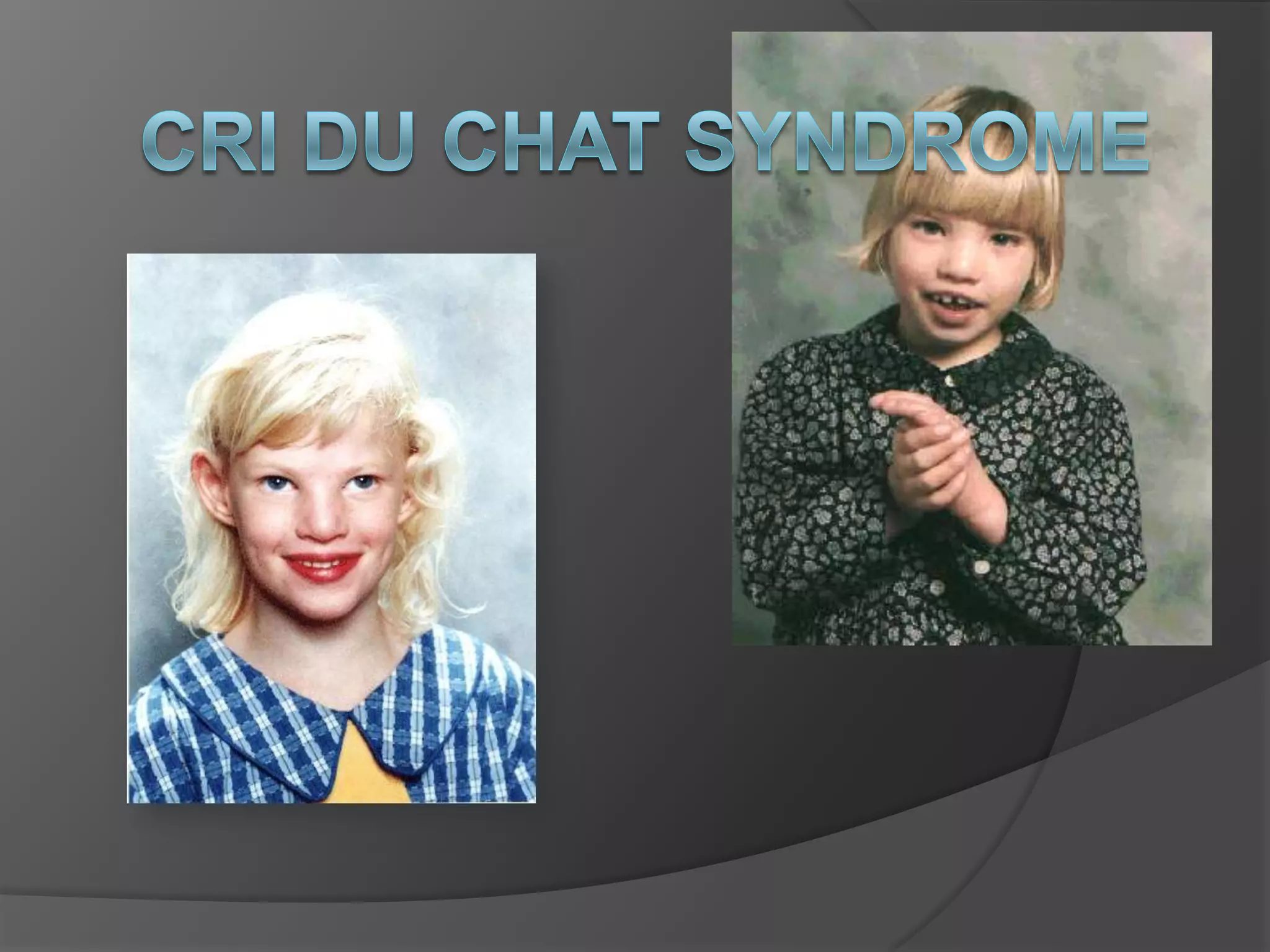 Cri du chat syndrome | PPTX