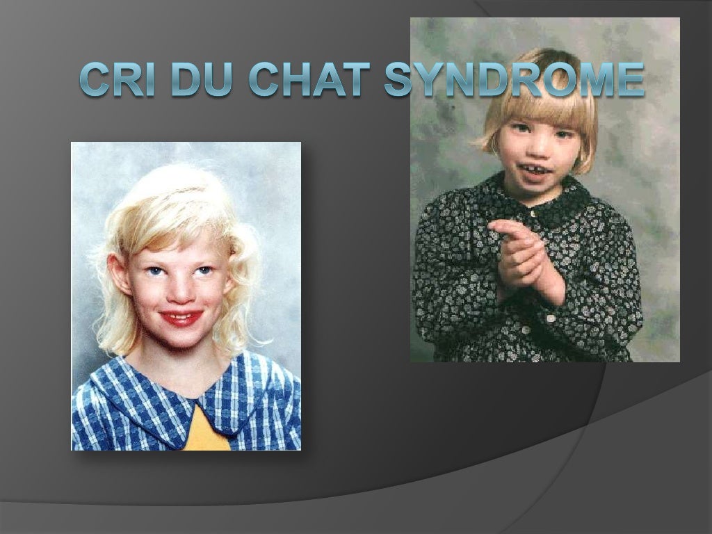 Cri du chat syndrome
