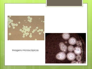 Criptococose pulmonar | PPTX