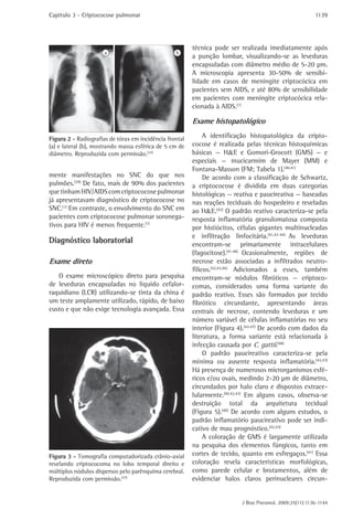 Criptococose pulmonar sbpt 2009 | PDF