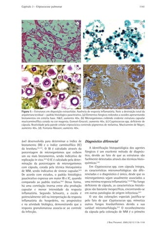 Criptococose pulmonar sbpt 2009 | PDF