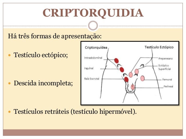 Criptorquídia