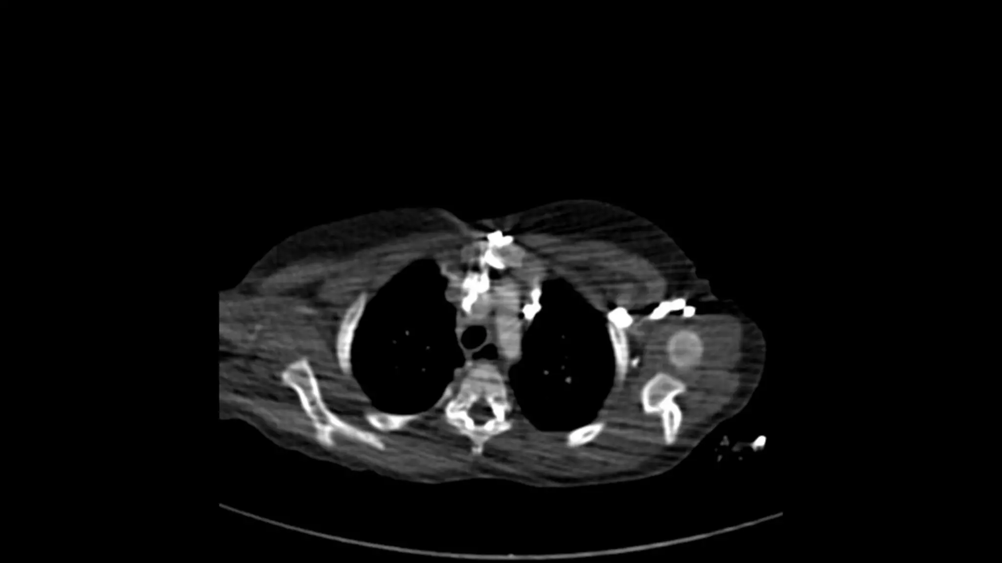 Criss cross , Veno-venous collaterals , TGA | PPTX