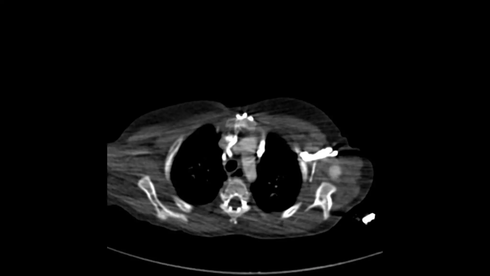 Criss cross , Veno-venous collaterals , TGA | PPTX