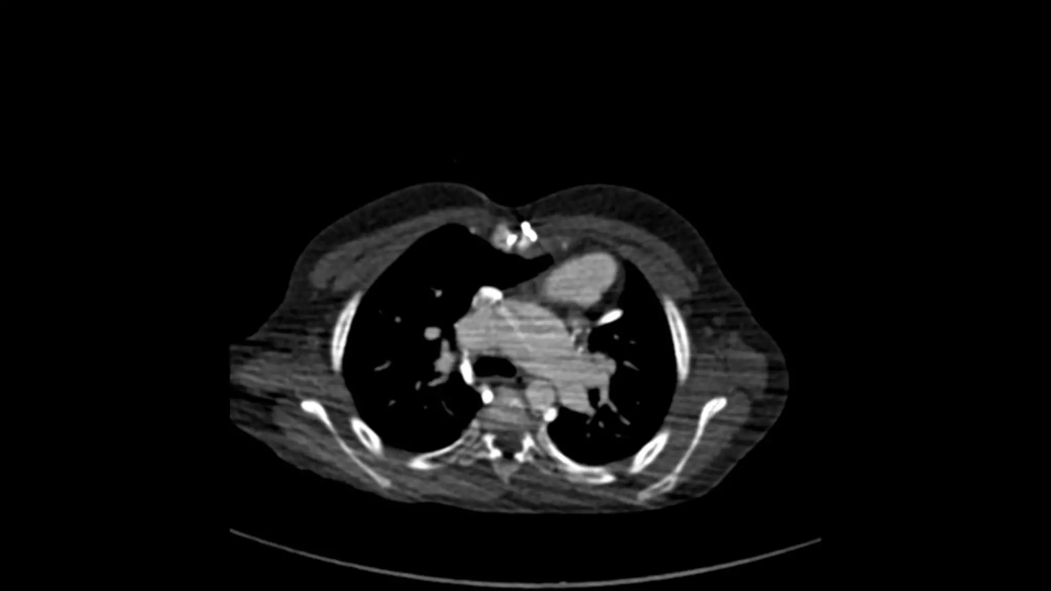 Criss cross , Veno-venous collaterals , TGA | PPTX
